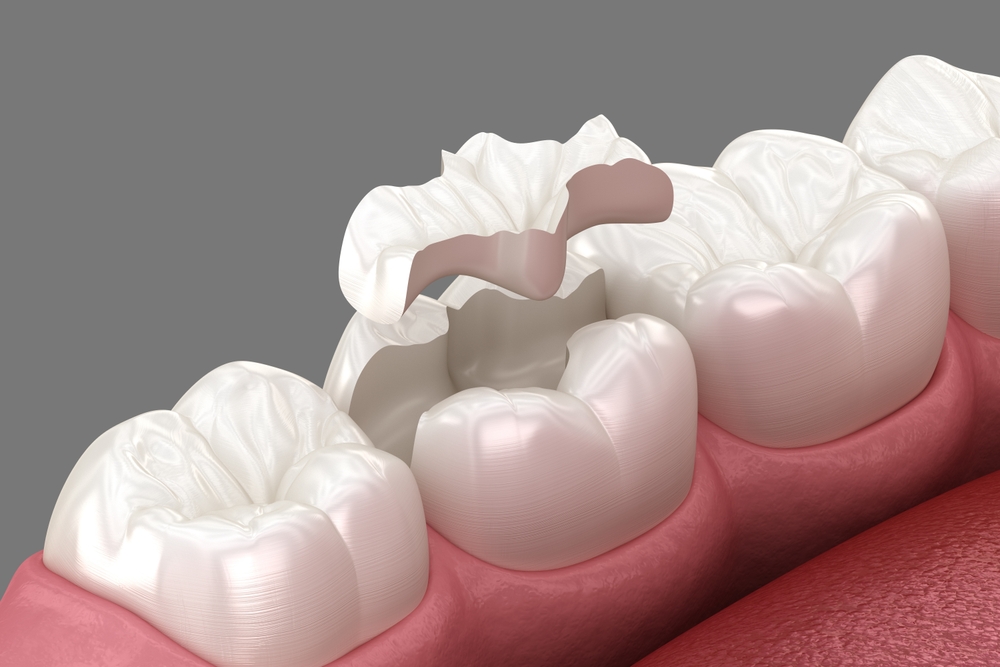 Ceramic Dental Fillings in Honolulu, HI | Dentist Near Me